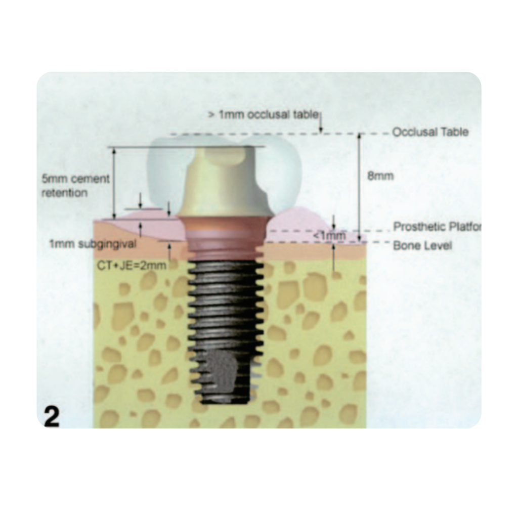 How Much Crown Height Space? – Implant Ninja