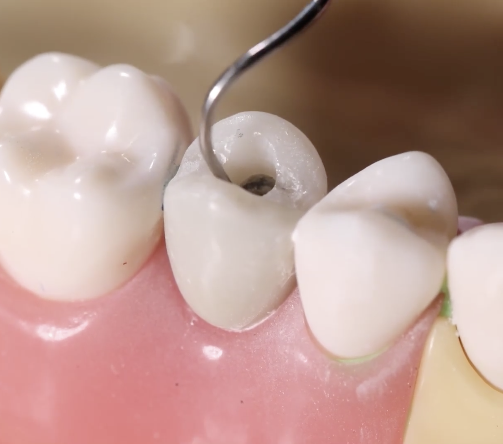 How to Access An Implant Crown - Implant Ninja